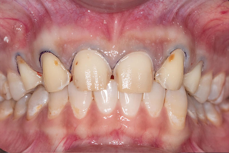 Smile Gallery & Case Studies | Dapto Dentists