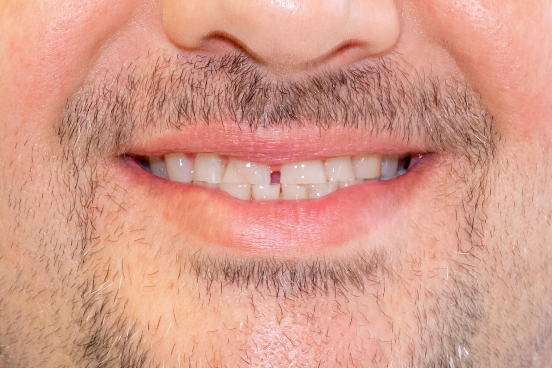 Smile Gallery & Case Studies | Dapto Dentists