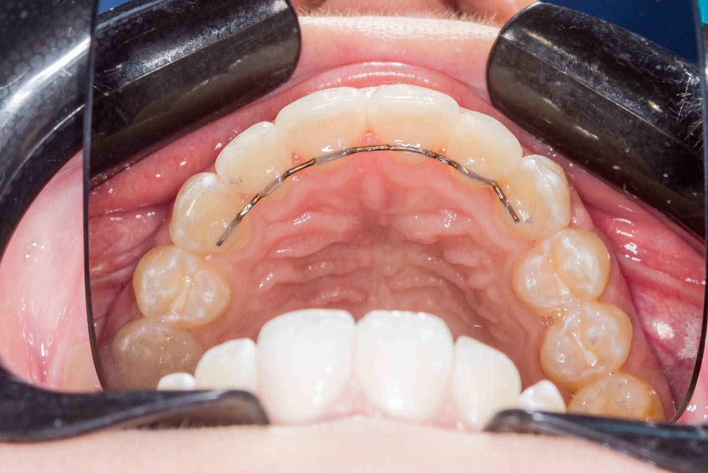 Smile Gallery & Case Studies | Dapto Dentists