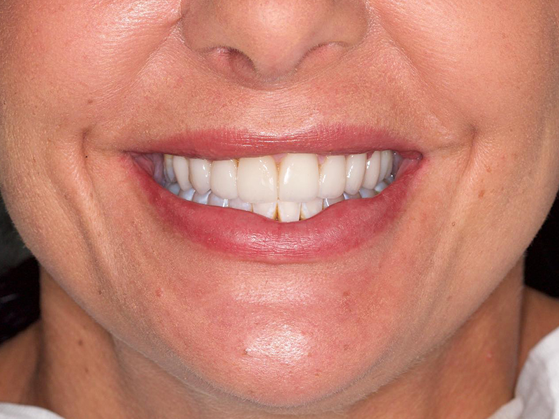 Smile Gallery & Case Studies | Dapto Dentists